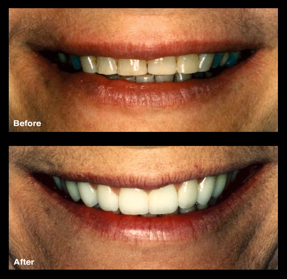 Enamel Restoration | Worn Tooth Repair Thomasville | Signature Smiles