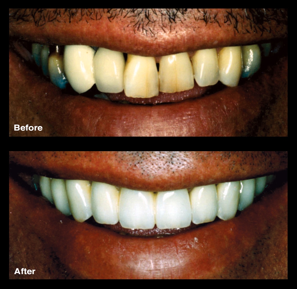 Enamel Restoration | Worn Tooth Repair Thomasville | Signature Smiles